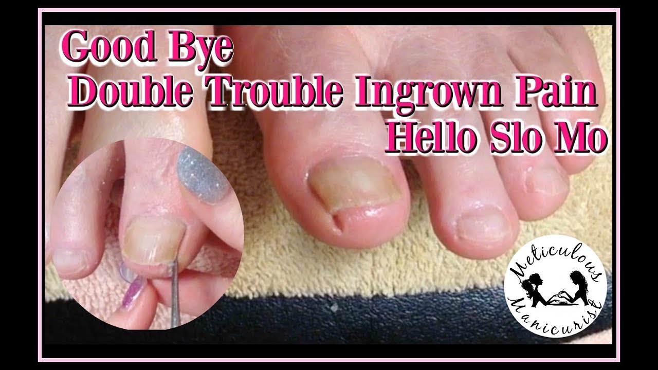 Double Trouble Ingrown Toenail Lesson ⭐ - YouTube