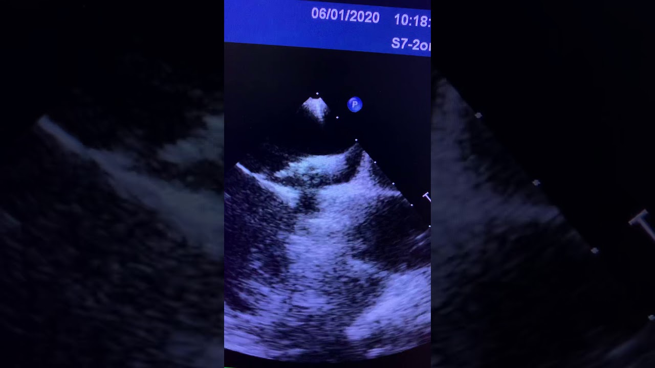 PFO balloon sizing - YouTube