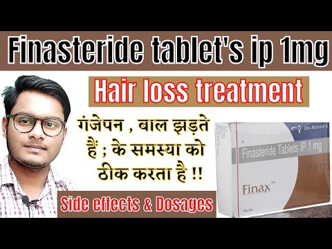Finasteride | Finasteride results |Finasteride 1mg results|Finax tablet ...