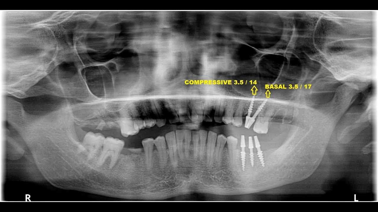 Infected root stump of upper molar extraction and immediate loading of ...