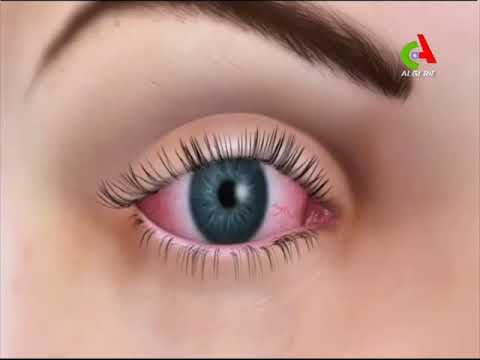Santé Mag: Sécheresse oculaire : définition, symptômes et causes. - YouTube