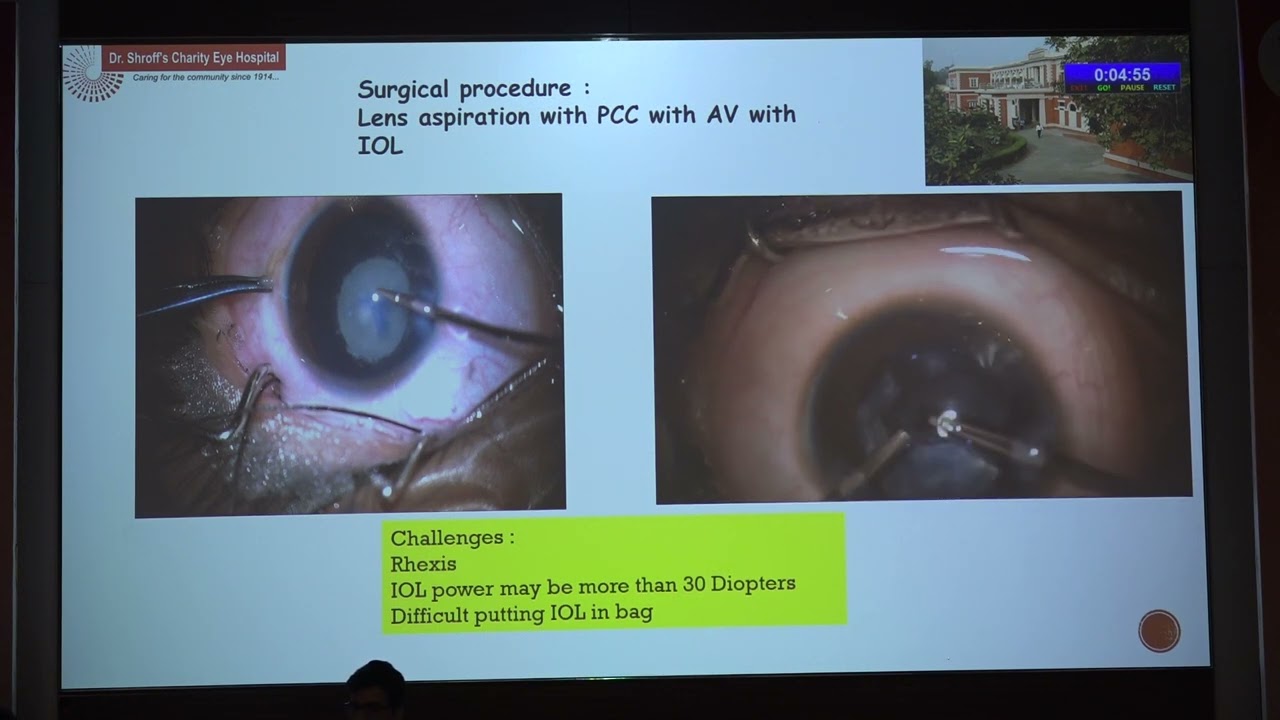 AIOC2022 GP36 topic Dr SUMA GANESH Pediatric Cataract Surgery in ...