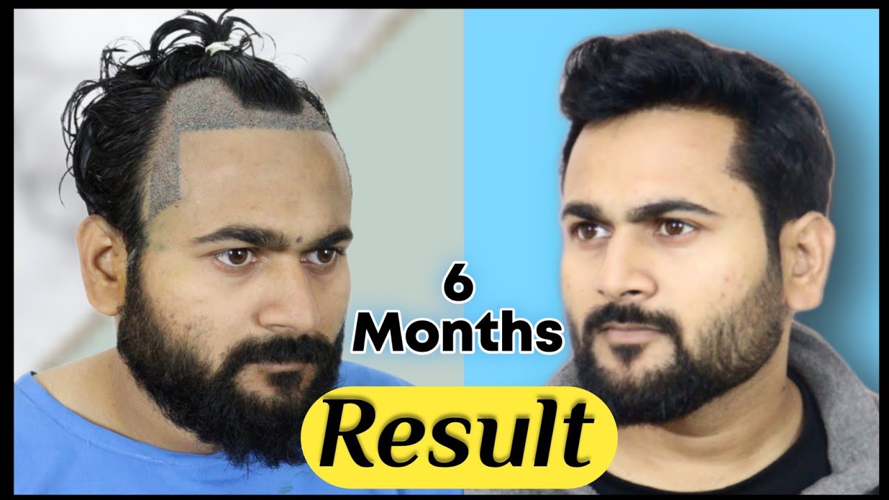 6 Months Hair Transplant Result || Patient Review || 6 months journey ...