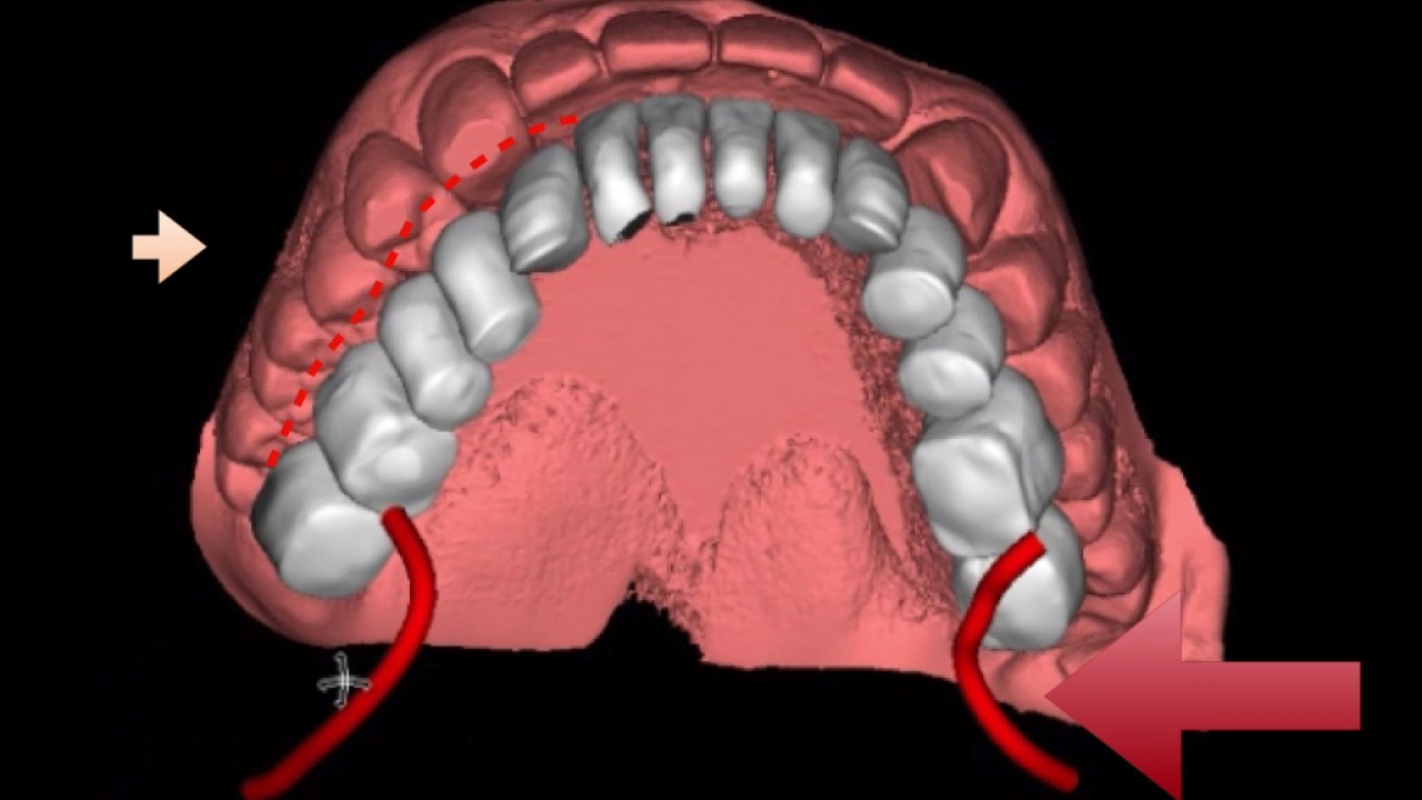 Correcting a Reverse Smile by Digital Smile Design concept - YouTube
