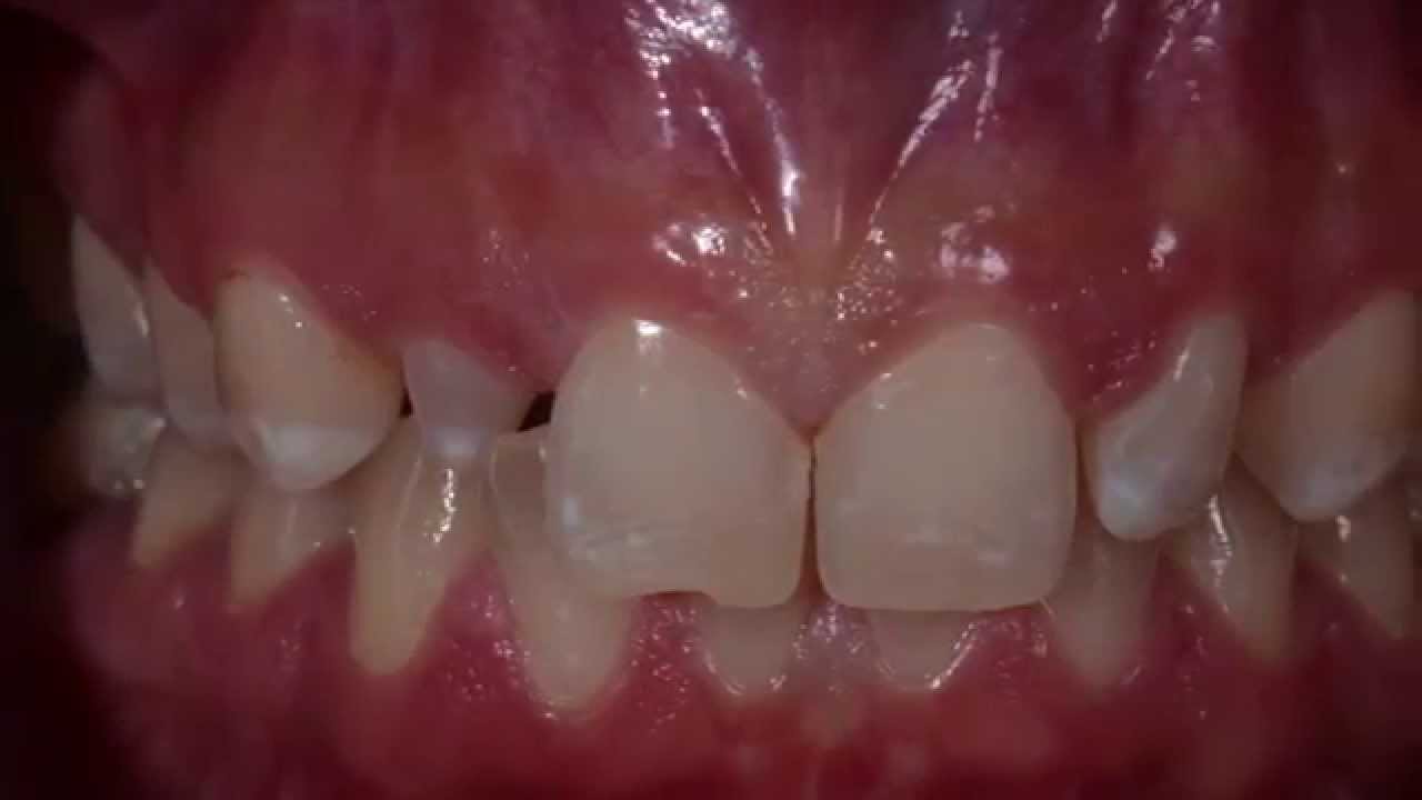 HanzaDent Naeratuse sünd - YouTube