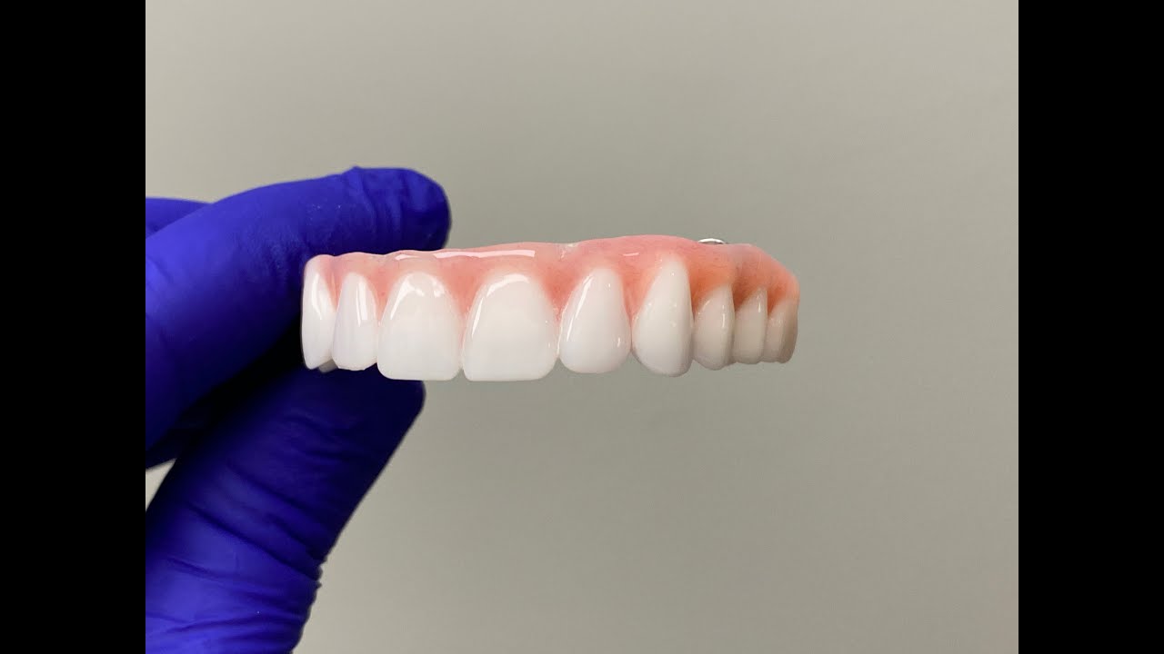 All on 4 - Implant Retained Denture - Wrap Around Bar design - YouTube