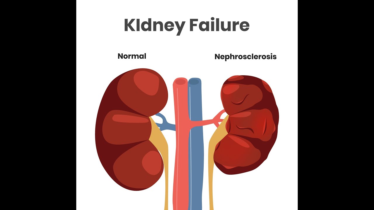Nephrosclerosis (hardening sclerosis of the small arteries and ...