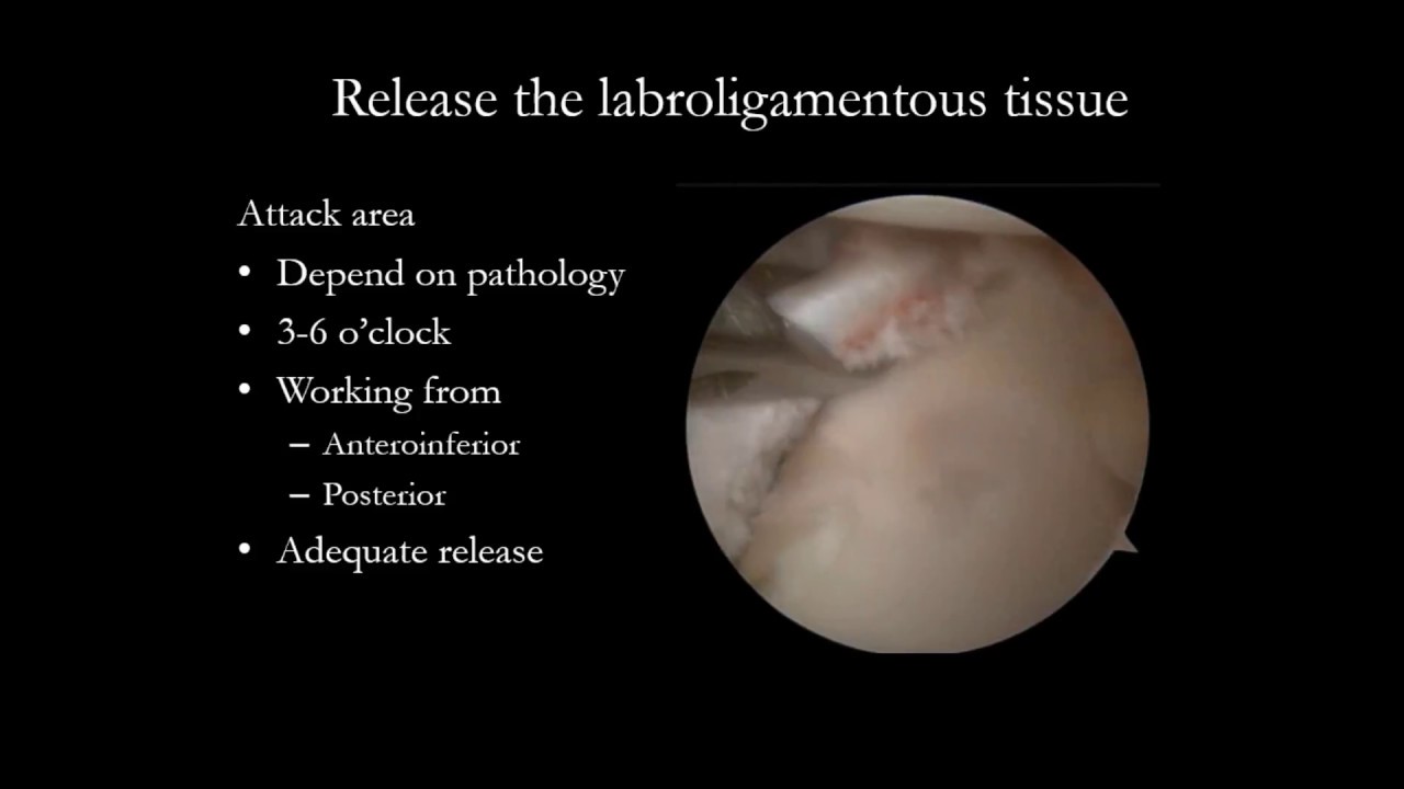 05 Bankart SLAP Aj Ekawit TOSSM fellow workshop - YouTube