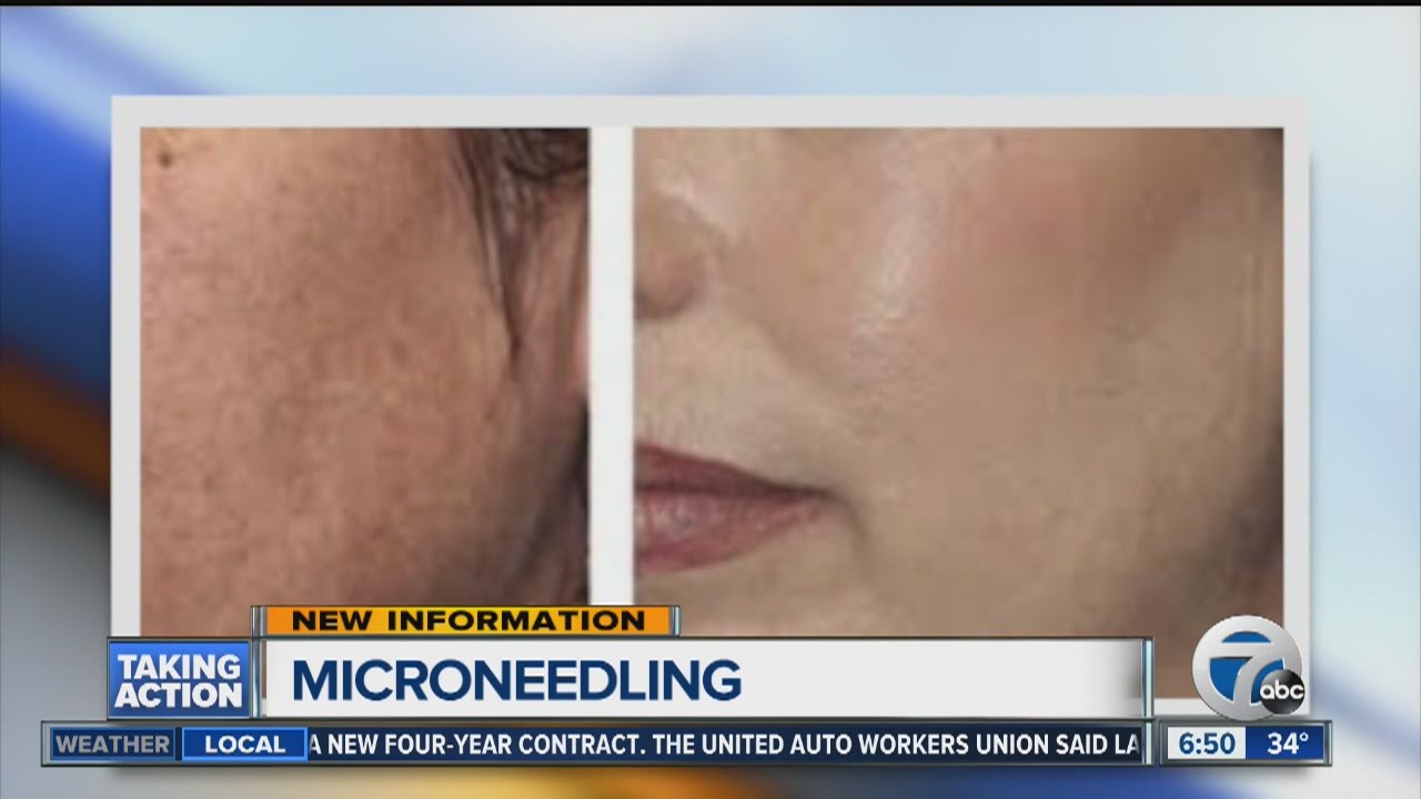 Microneedling helps firm skin and reduce wrinkles - YouTube