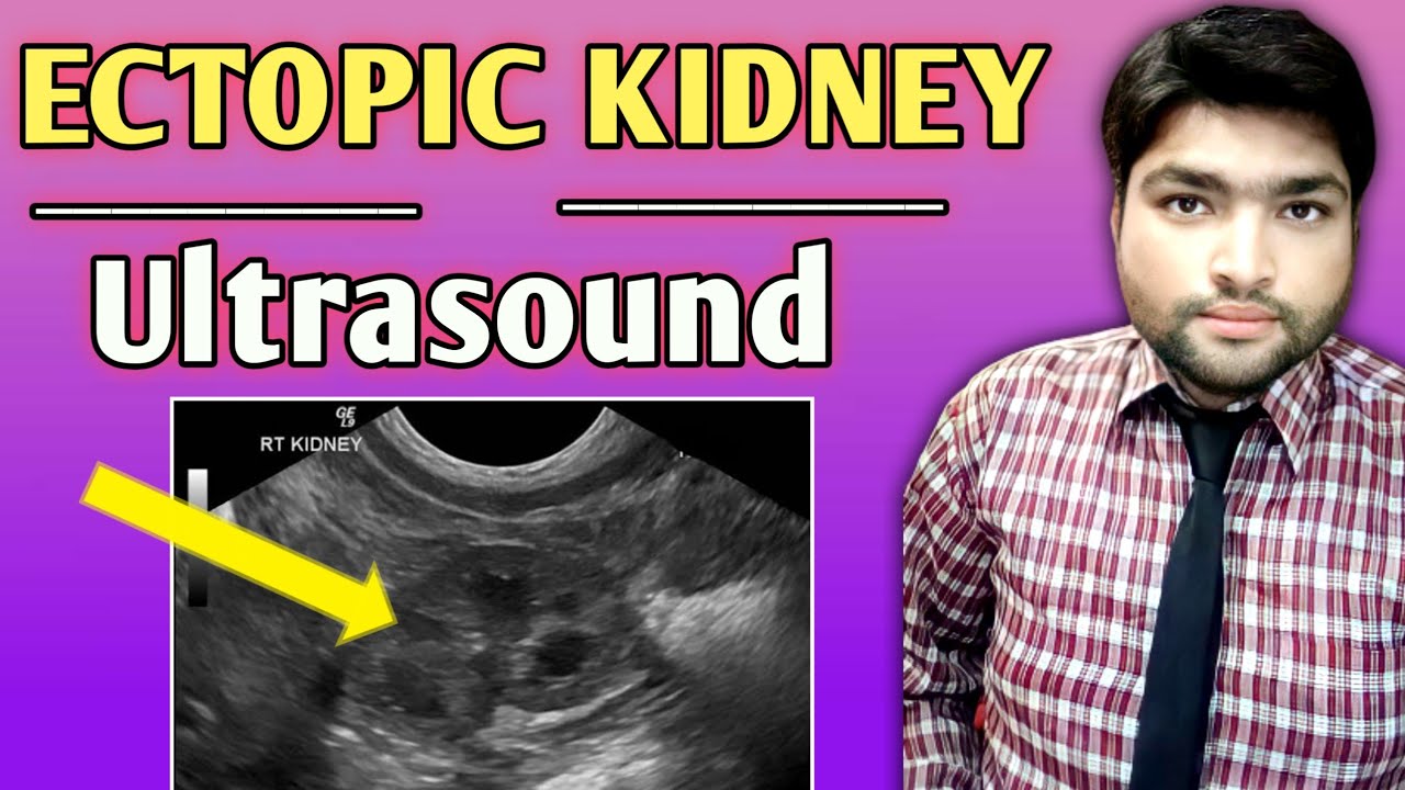Ectopic Kidney Ultrasound | What is ectopic Kidney ? by Dr Ali Waqar ...