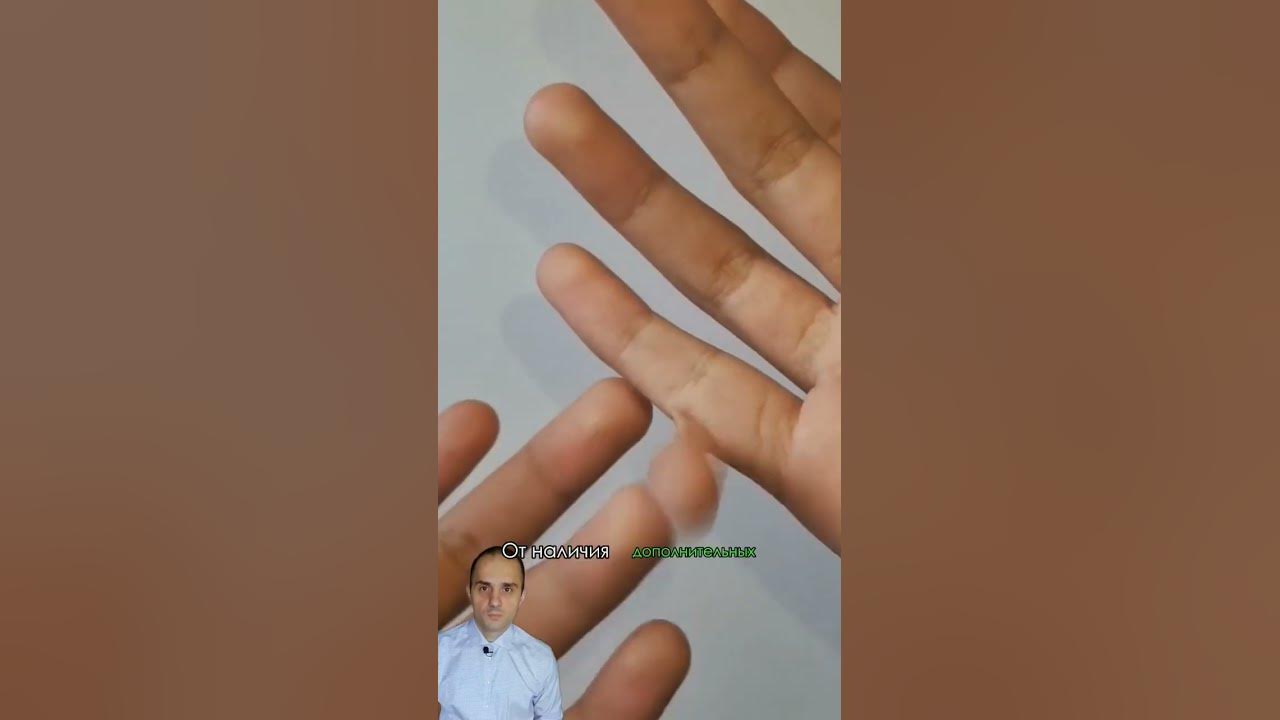 полидактилия - YouTube