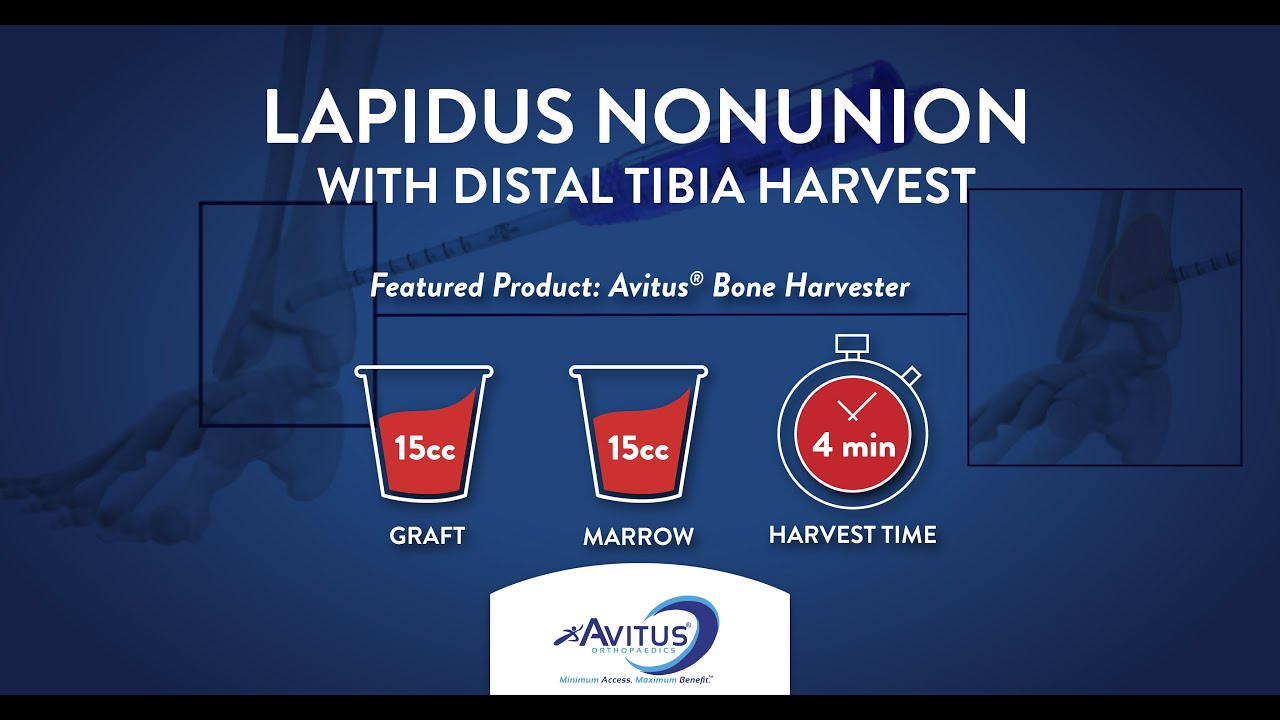 Avitus® Bone Harvester - MIS Distal Tibia Harvest - YouTube