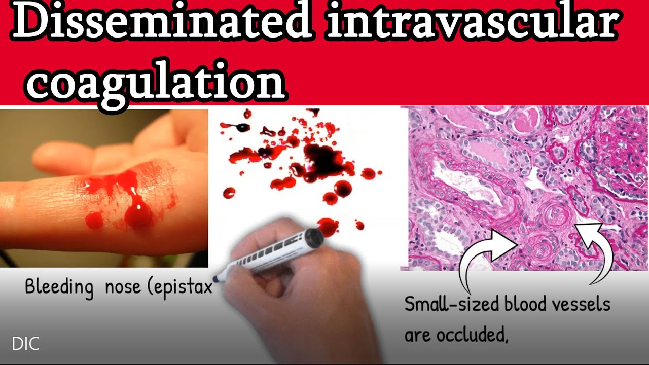 Disseminated Intravascular Coagulation DIC Causes Symptoms