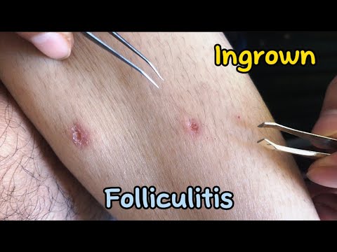 [ASMR] solve all folliculitis and ingrown hairs for ms LeTo - YouTube