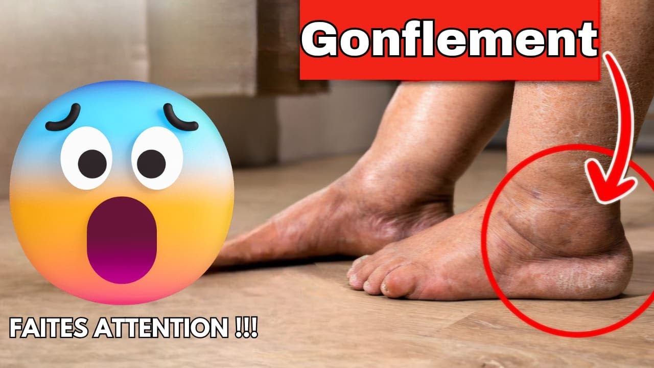 Vitamine n°1 pour éliminer les jambes et chevilles enflées... - YouTube
