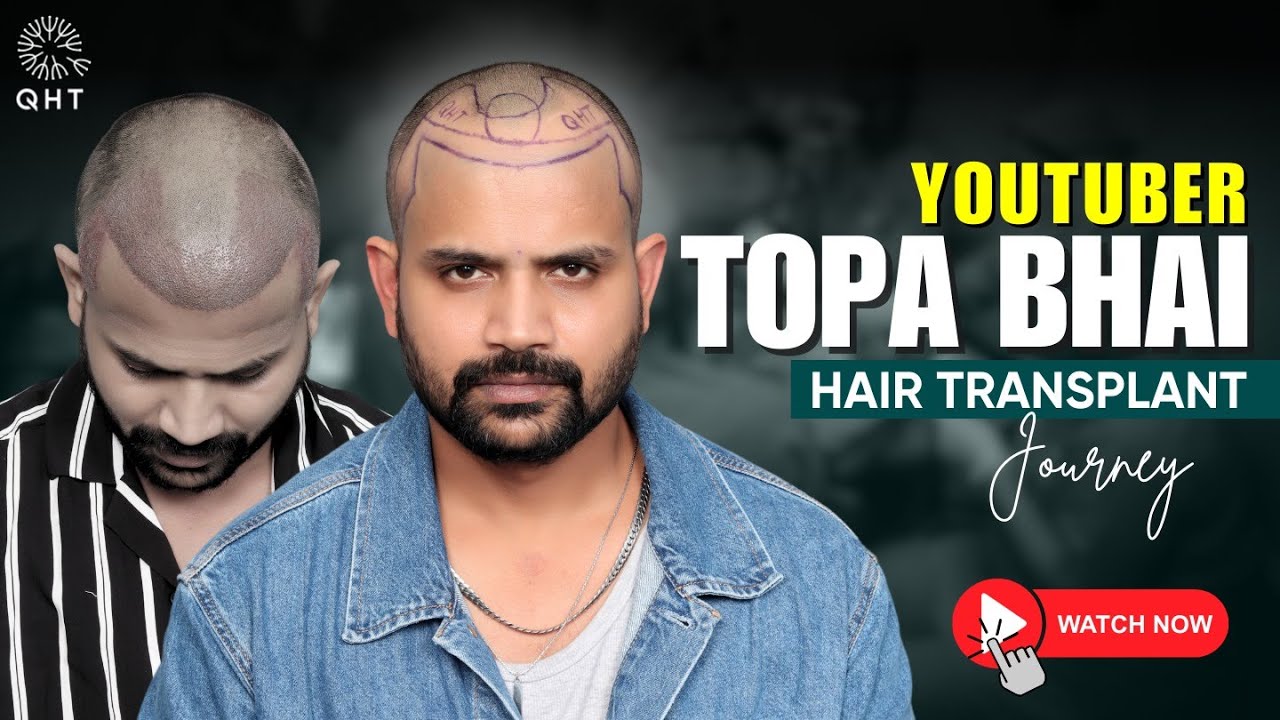 Nadeem Bunny Topa Bhai Hair Transplant | Sevengers Hair Transplant ...