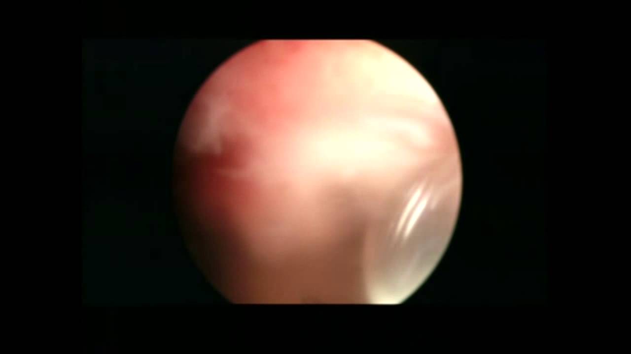 Bursectomia parcial y Acromioplastia - YouTube