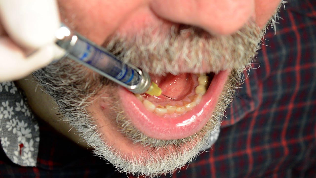 lingual infiltration - YouTube