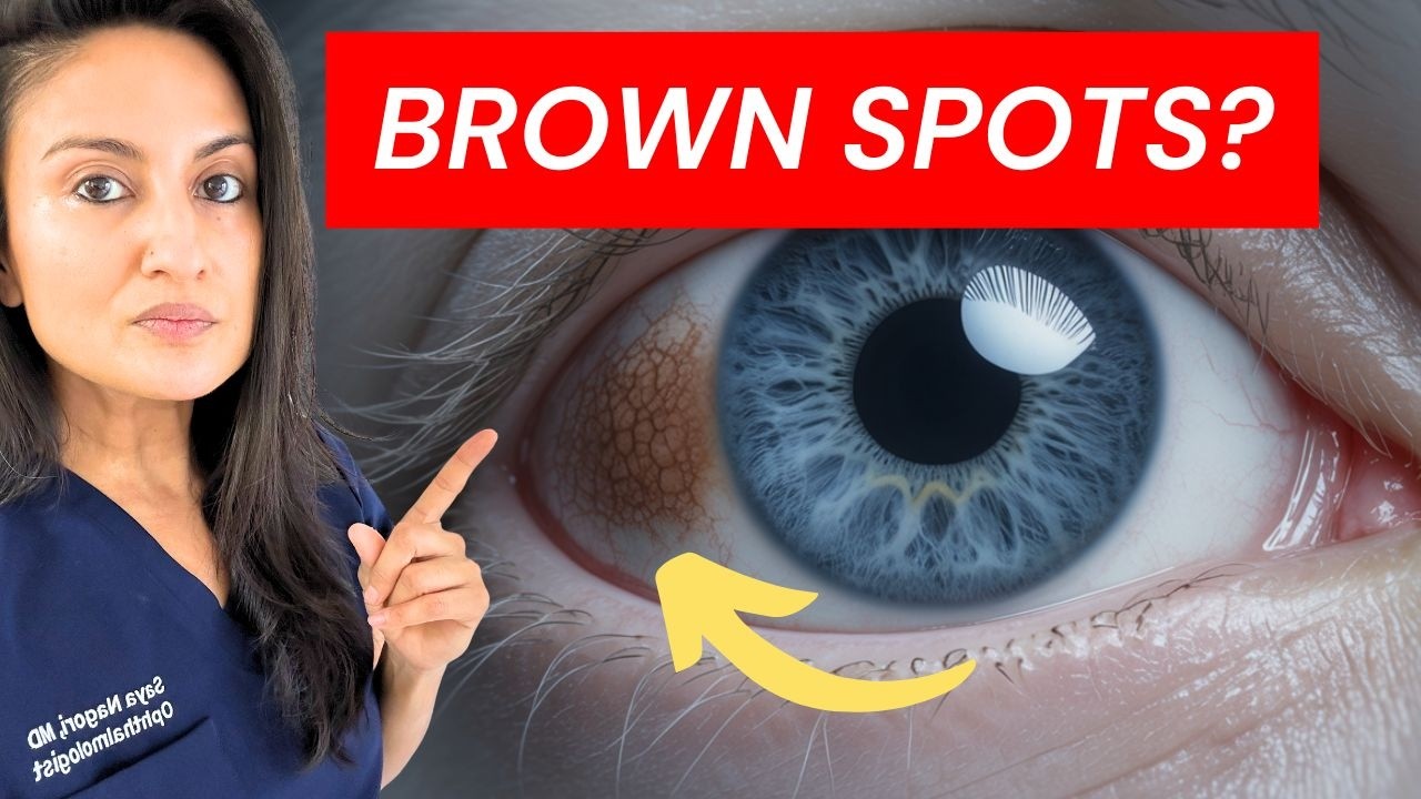 Doctor Explains Which Brown Spots On The Eye Are Dangerous - YouTube