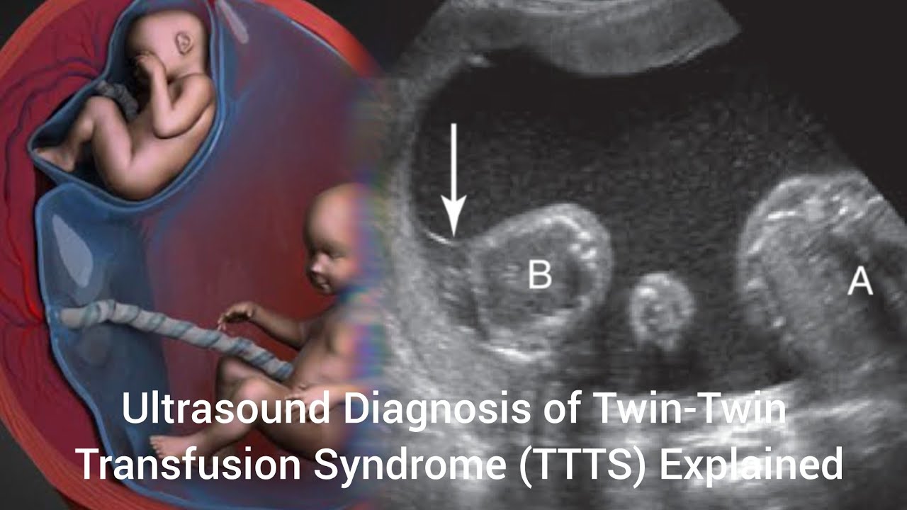 Ultrasound diagnosis of Twin-Twin Transfusion Syndrome (TTTS) Explained ...