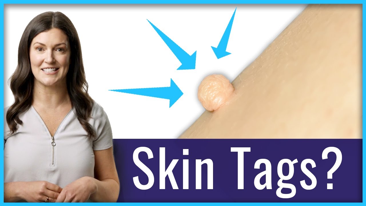 How To Remove Skin Tags TagBand - YouTube