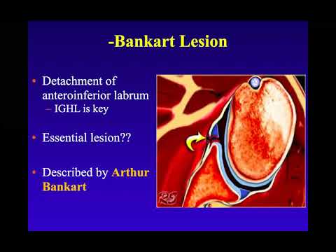 Shoulder instability By Dr Ahmed Hatem