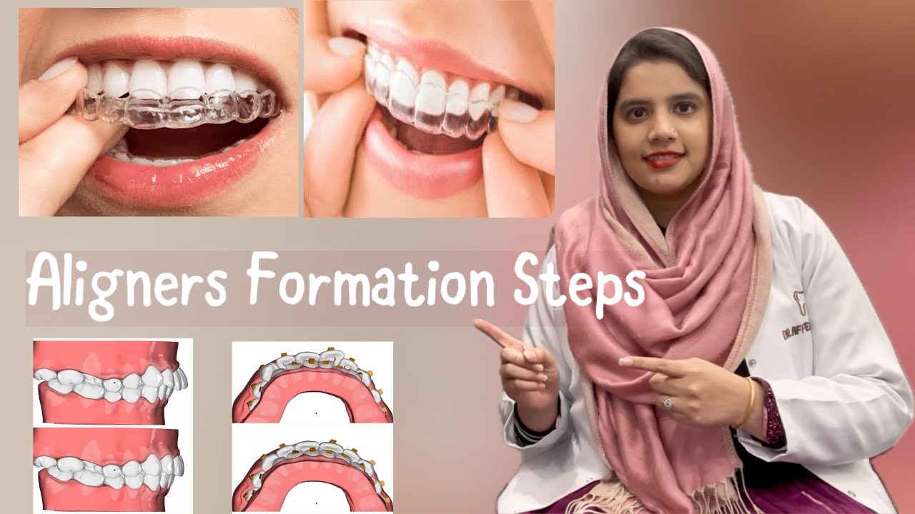 Aligners Formation Steps| Complete Guidance Regarding Aligners| Dental ...