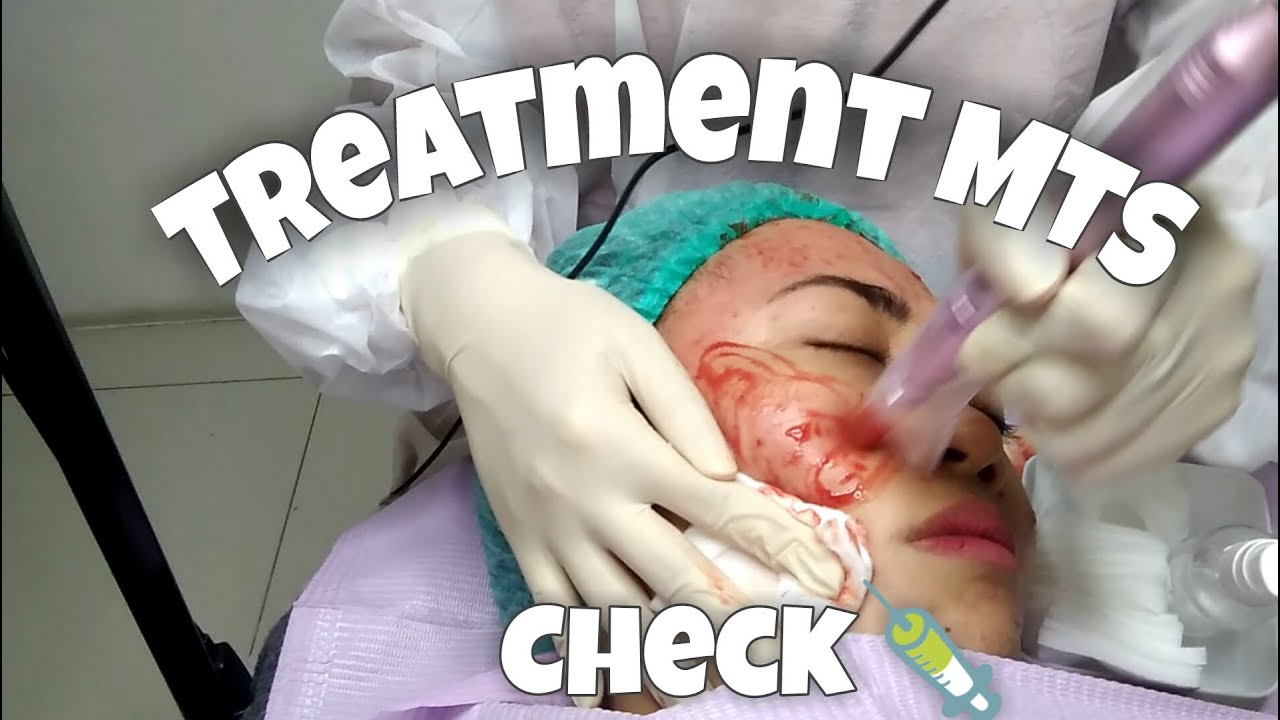 Tahapan Lengkap Treatment Microneedling Therapy System (MTS ...