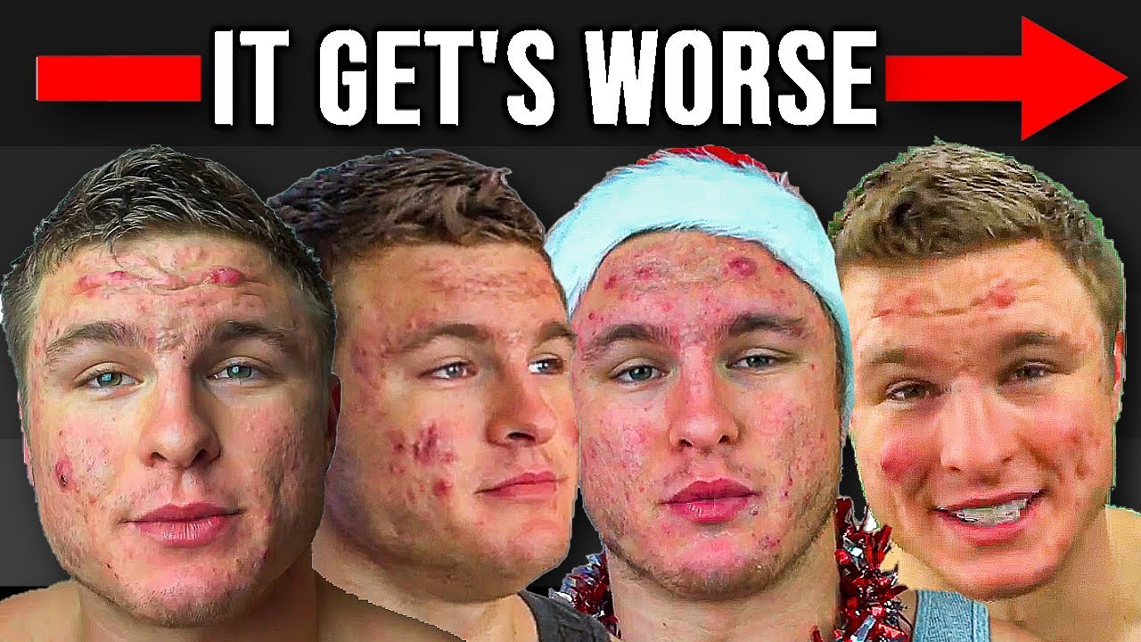 What The First 8 Weeks Of Accutane Looks Like (WEEK BY WEEK) - YouTube