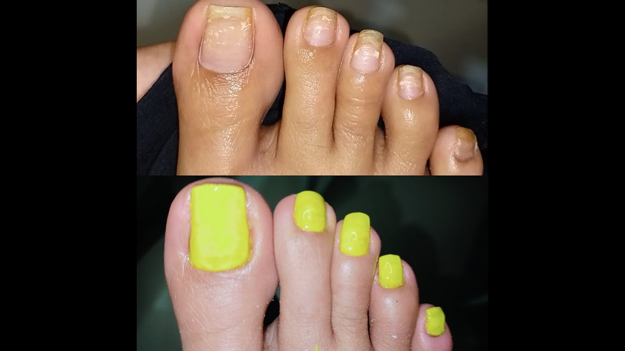 Toenail makeover Part 1 - YouTube
