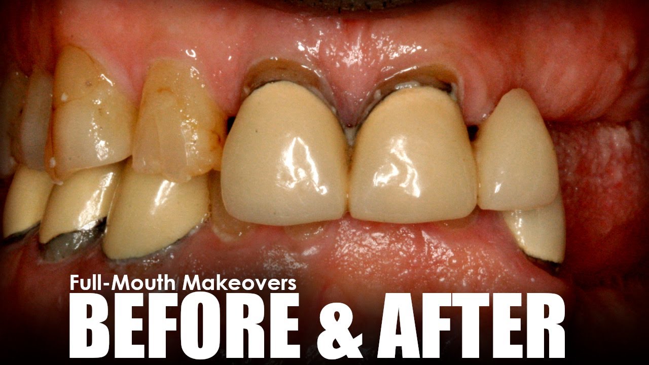 Before & After: Full-Mouth Cosmetic Makeovers - YouTube