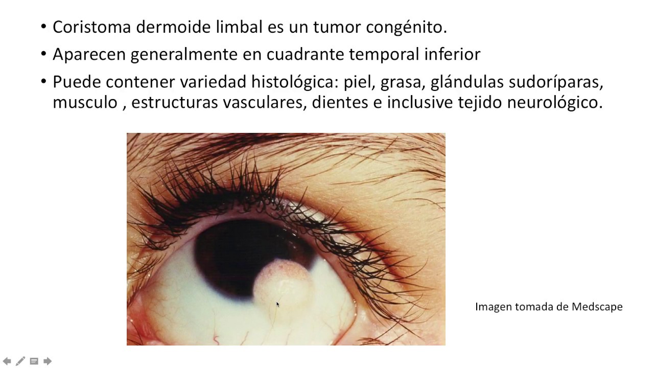Síndrome de Goldenhar y quiste dermoide por Daniel Acosta - YouTube