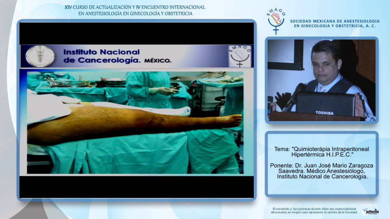 Quimioterápia Intraperitoneal Hipertérmica H.I.P.E.C. - Dr. Juan José ...