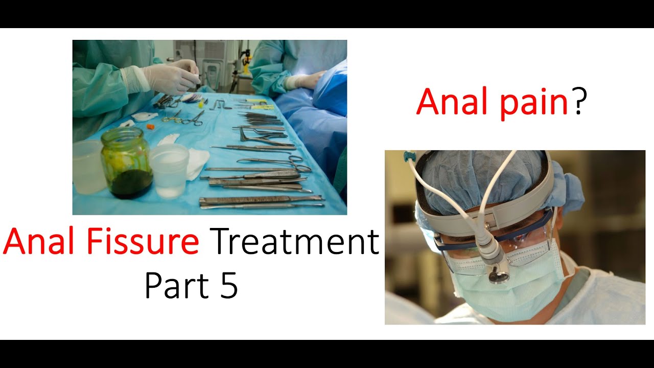 Surgery treatment for Anal Fissures (Part 5/5) - YouTube