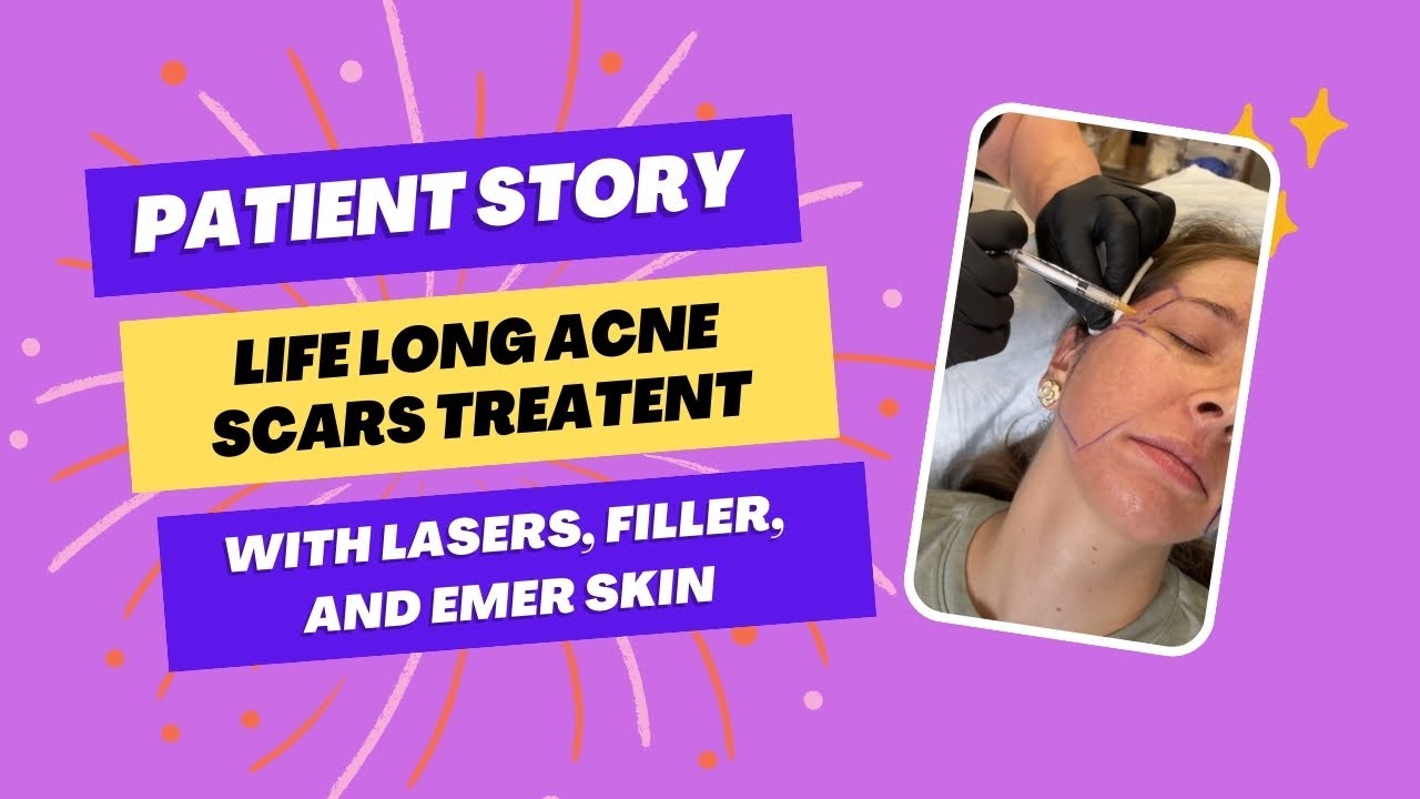 PATIENT STORY | LIFE LONG ACNE SCARS TREATENT WITH LASERS, FILLER, AND ...