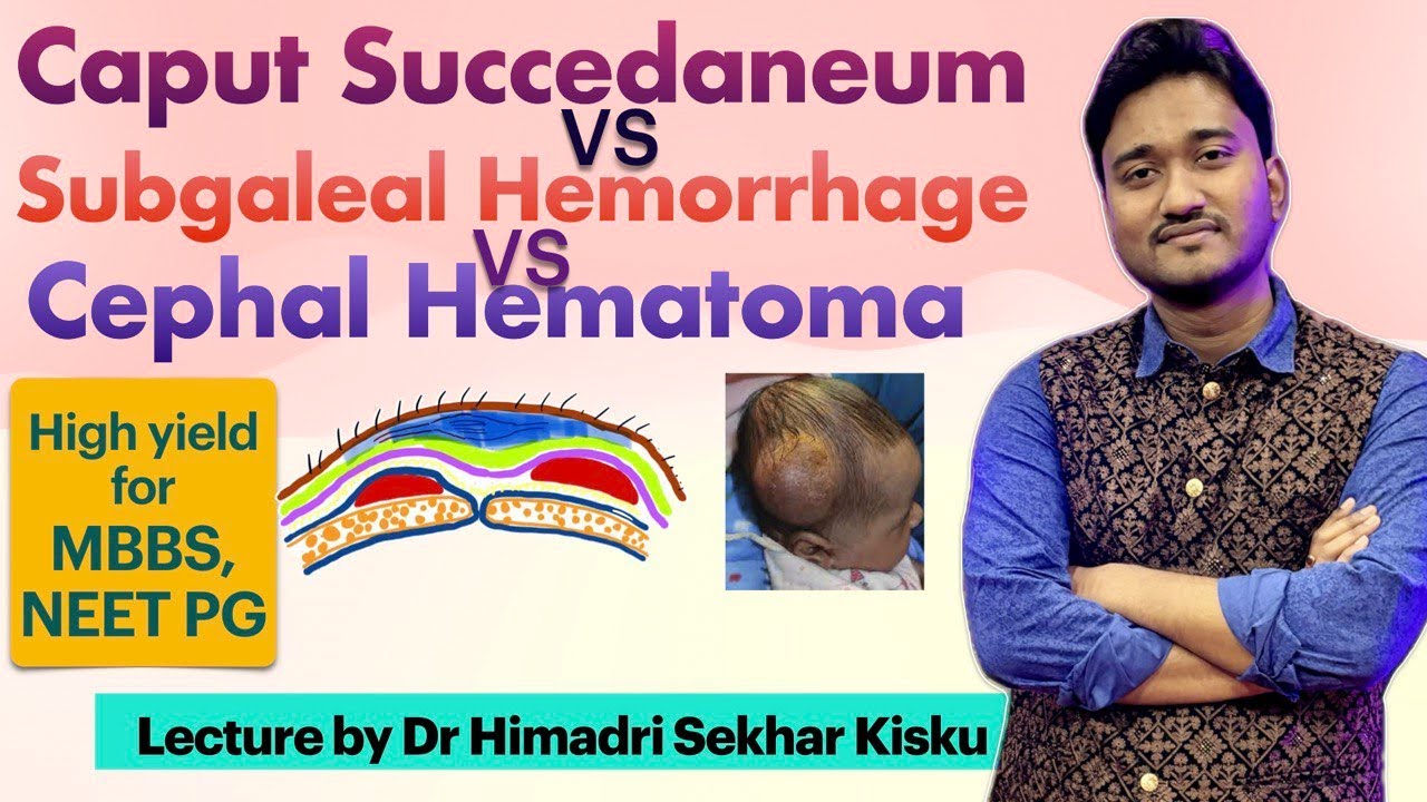 Caput Succedenum VS Subgaleal Hemorrhage VS Cephal Hematoma - YouTube