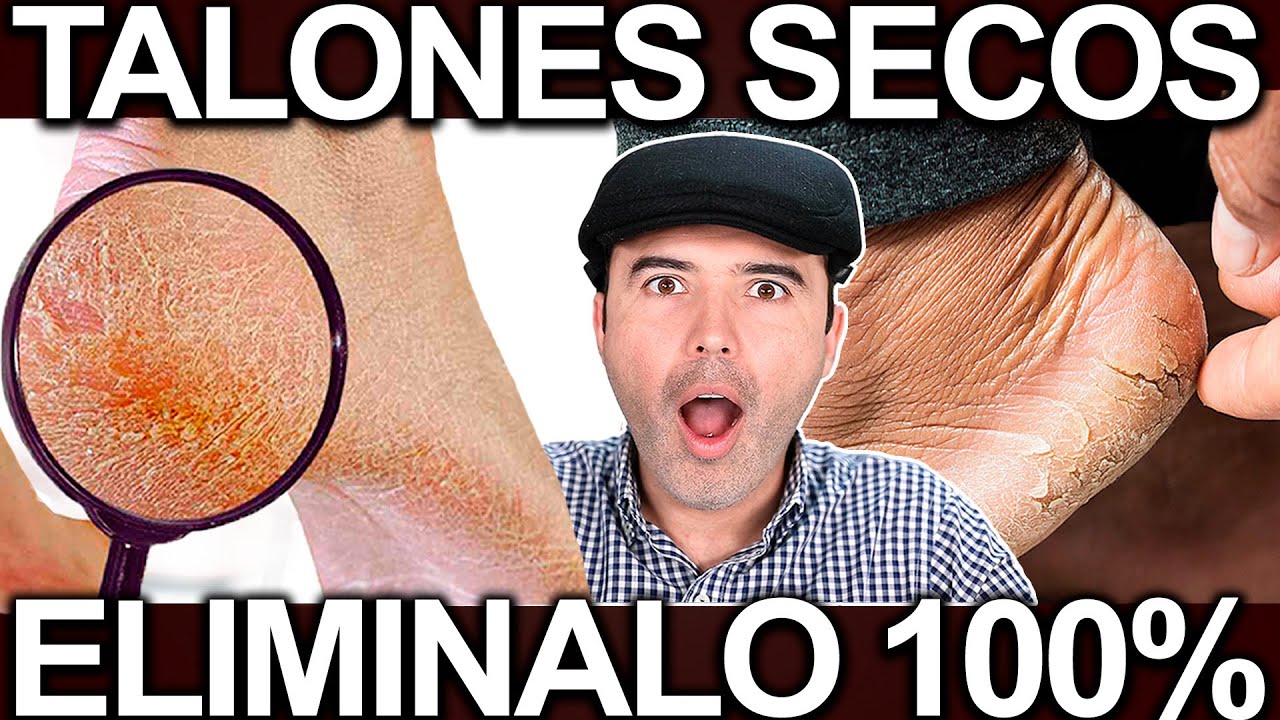 COMO REPARAR TALONES SECOS Y AGRIETADOS EN POCO TIEMPO 100% EFECTIVO ...
