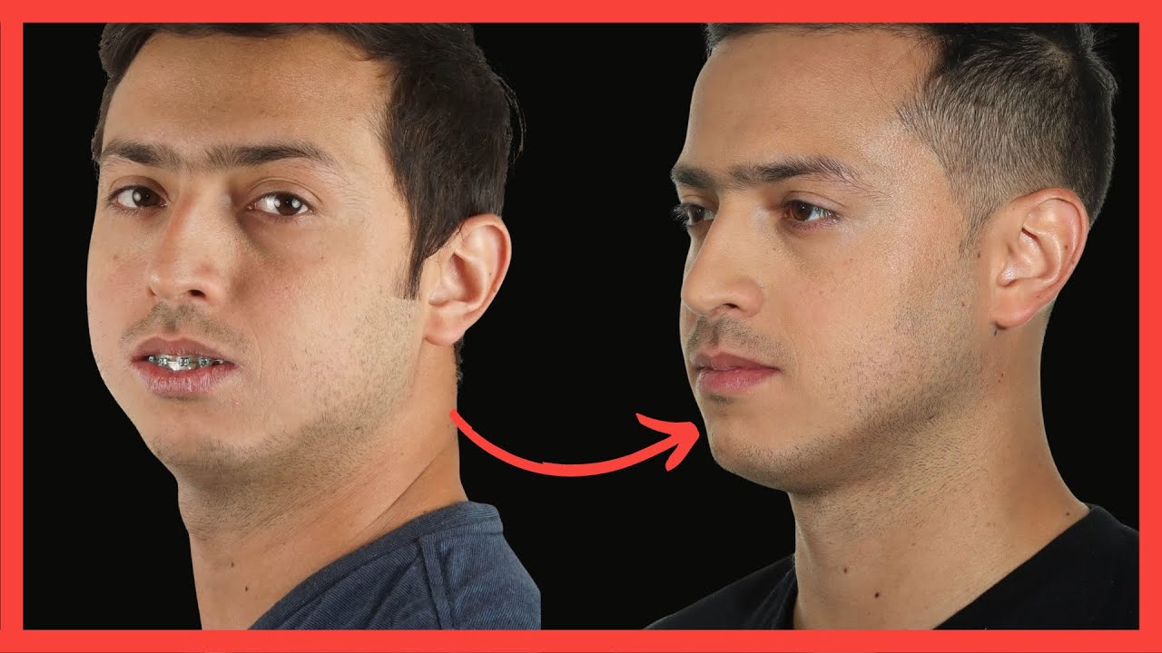 Caso clínico de Cirugía Ortognática de paciente Clase II - YouTube