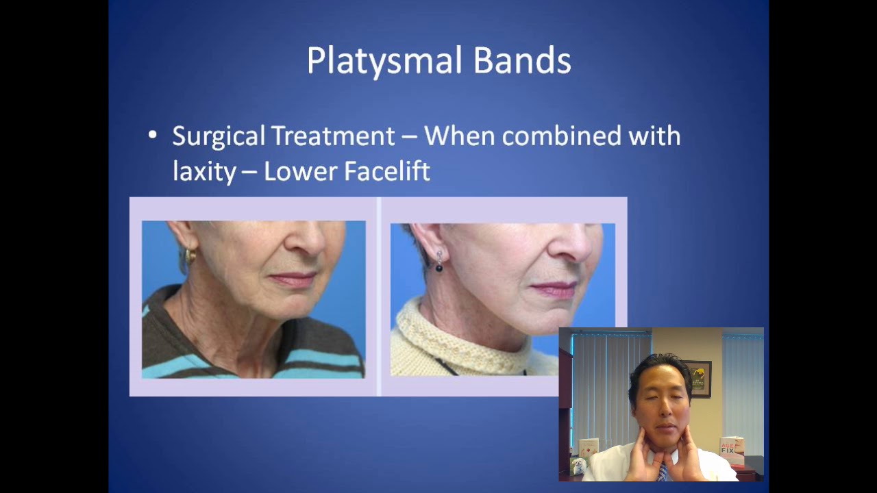 How Can I Soften the Look of my Neck - Platysmal Bands Consultation ...