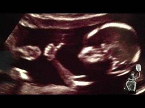 Super cool baby gives mum big thumbs up on ultrasound scan - YouTube