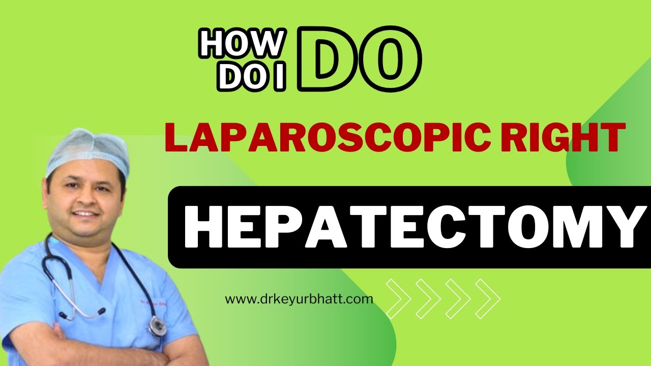 Laparoscopic Right hepatectomy | HCC | Liver resection | Lap liver ...