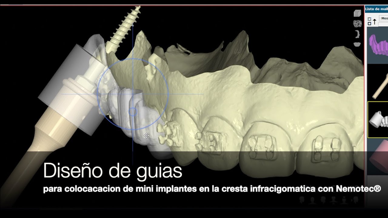 diseño de guia para mini implante en software Nemotec - YouTube