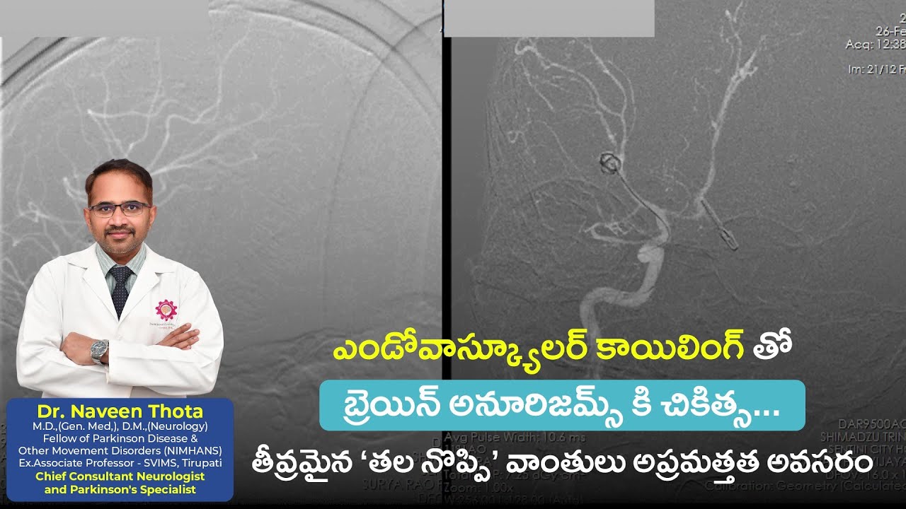 Endovascular Coiling for Brain Aneurysm | Dr Naveen Thota | Sentini ...