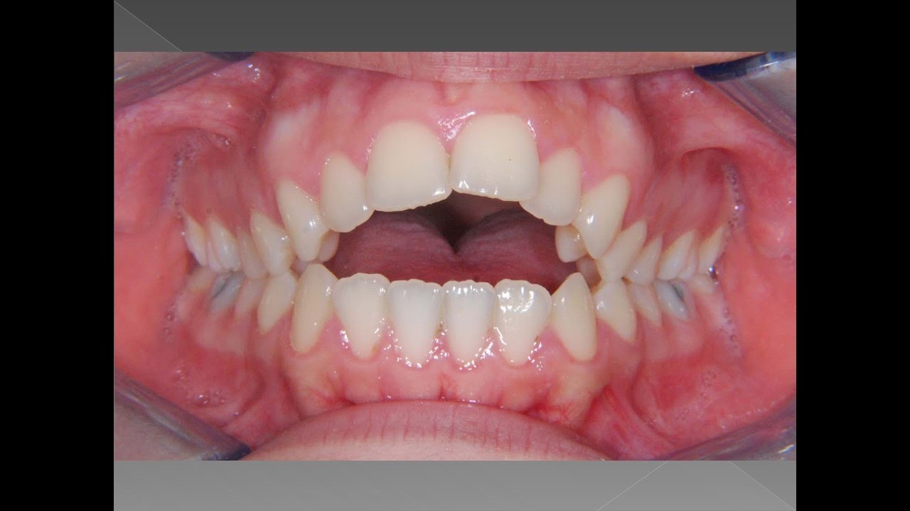 Amazing Open Bite Correction Explained By Orthodontist YouTube amazing-open-bite-correction-explained-by-orthodontist-youtube