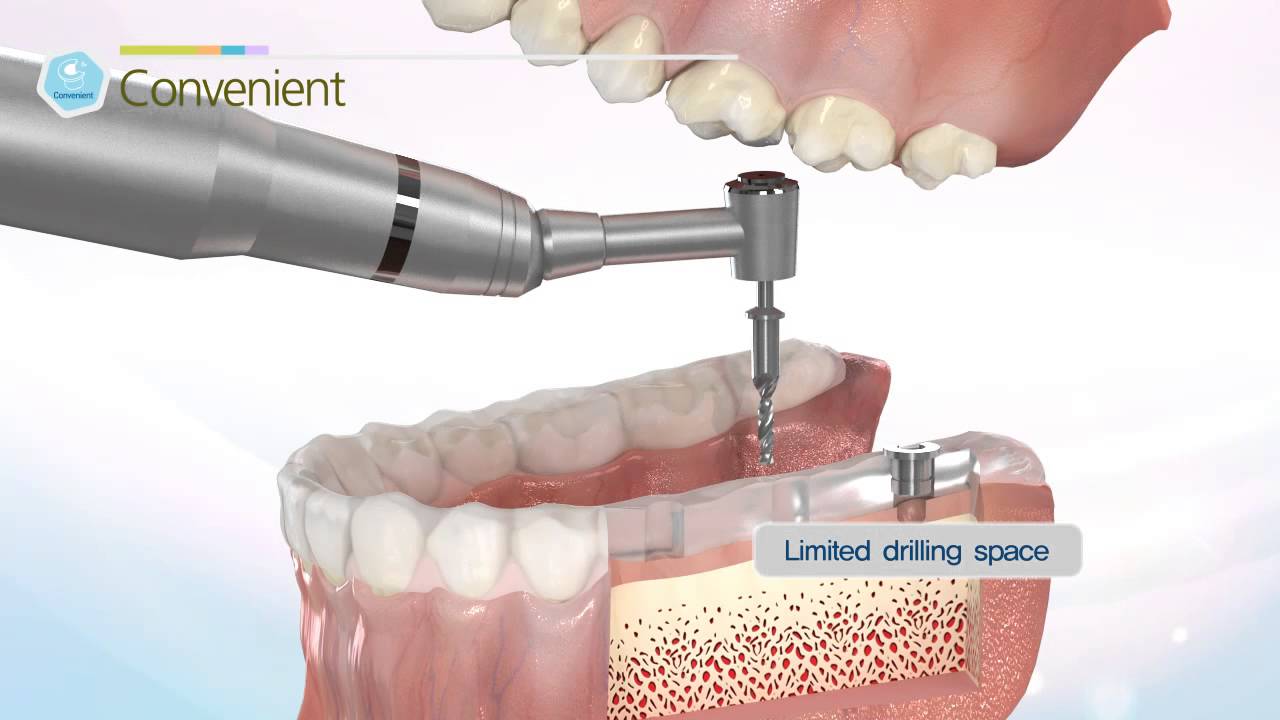 [DENTIS Dental Guide System] - SIMPLE GUIDE - YouTube