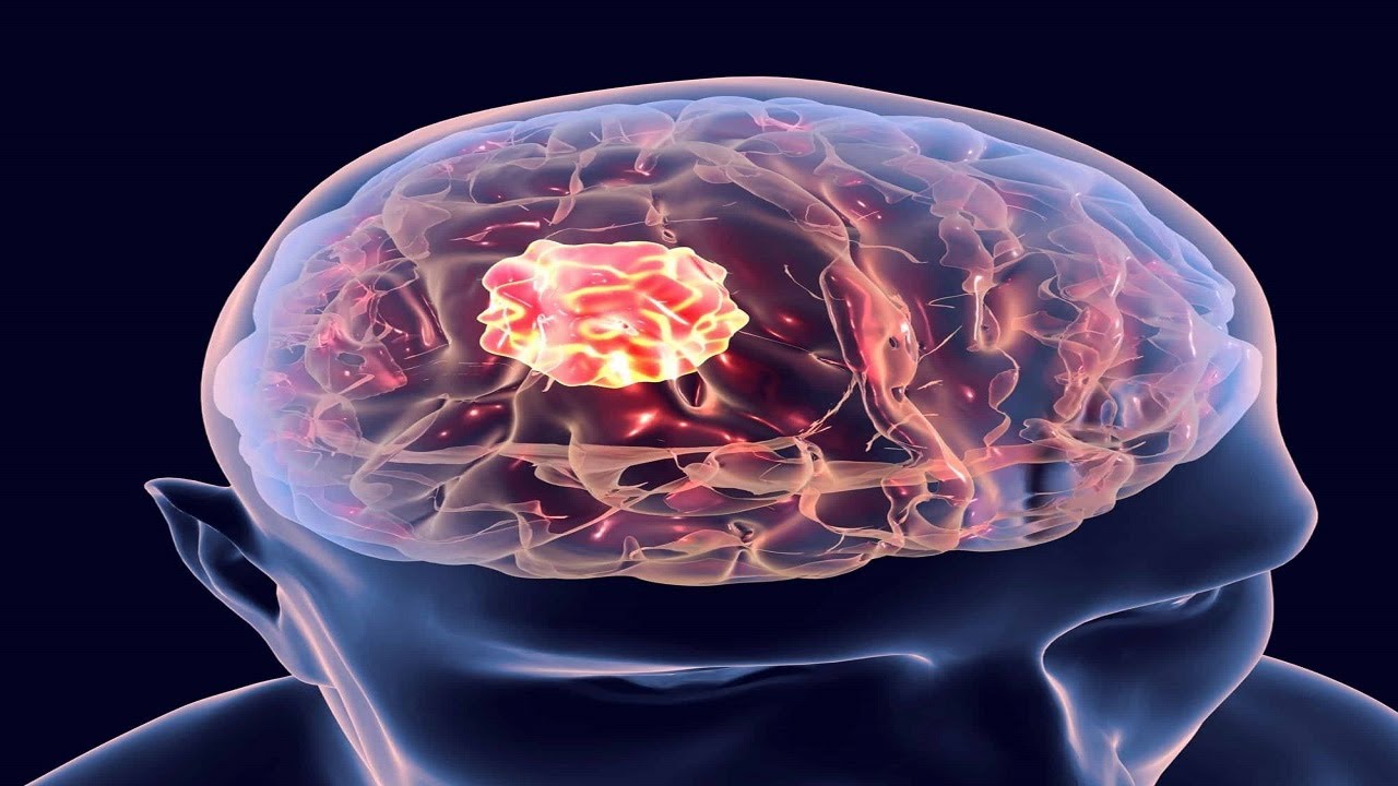 Vaccine shown to prolong life of patients with aggressive brain cancer ...