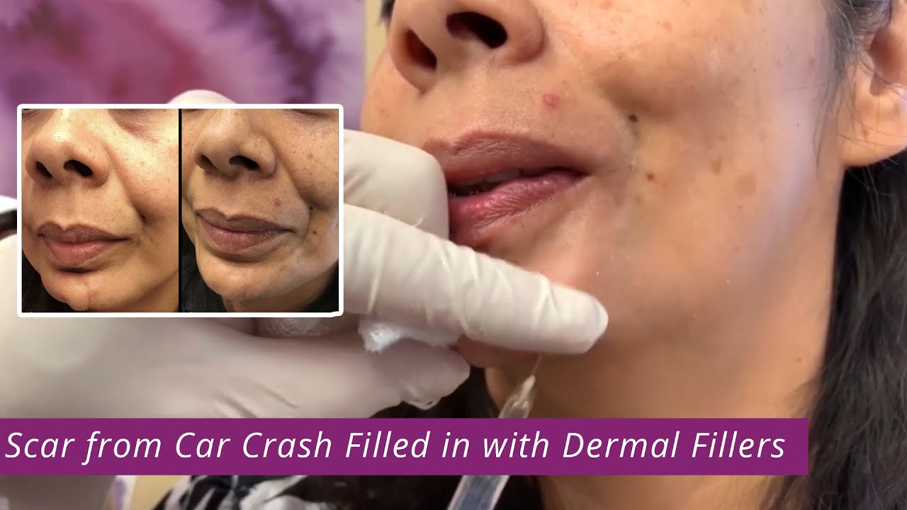 Filling Scar from Car Crash with #FillerInjections [See Before & Afters ...