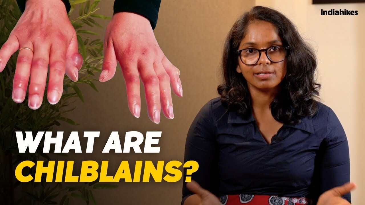 What are Chilblains? How to Treat Them Before It Is Too Late ...