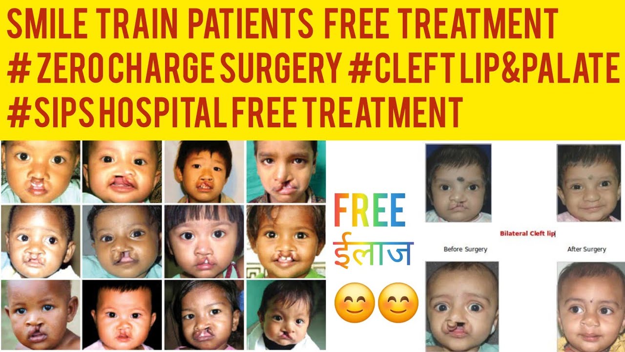 Smile train free treatment in detail #cleft palate & cleft lip surgery ...