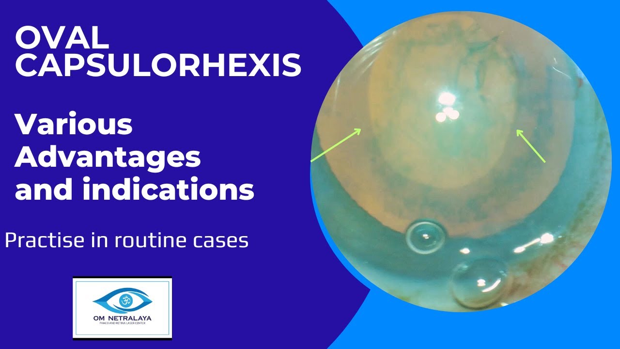 Case series 69. Oval Capsulorrhexis, various advantages and indications ...